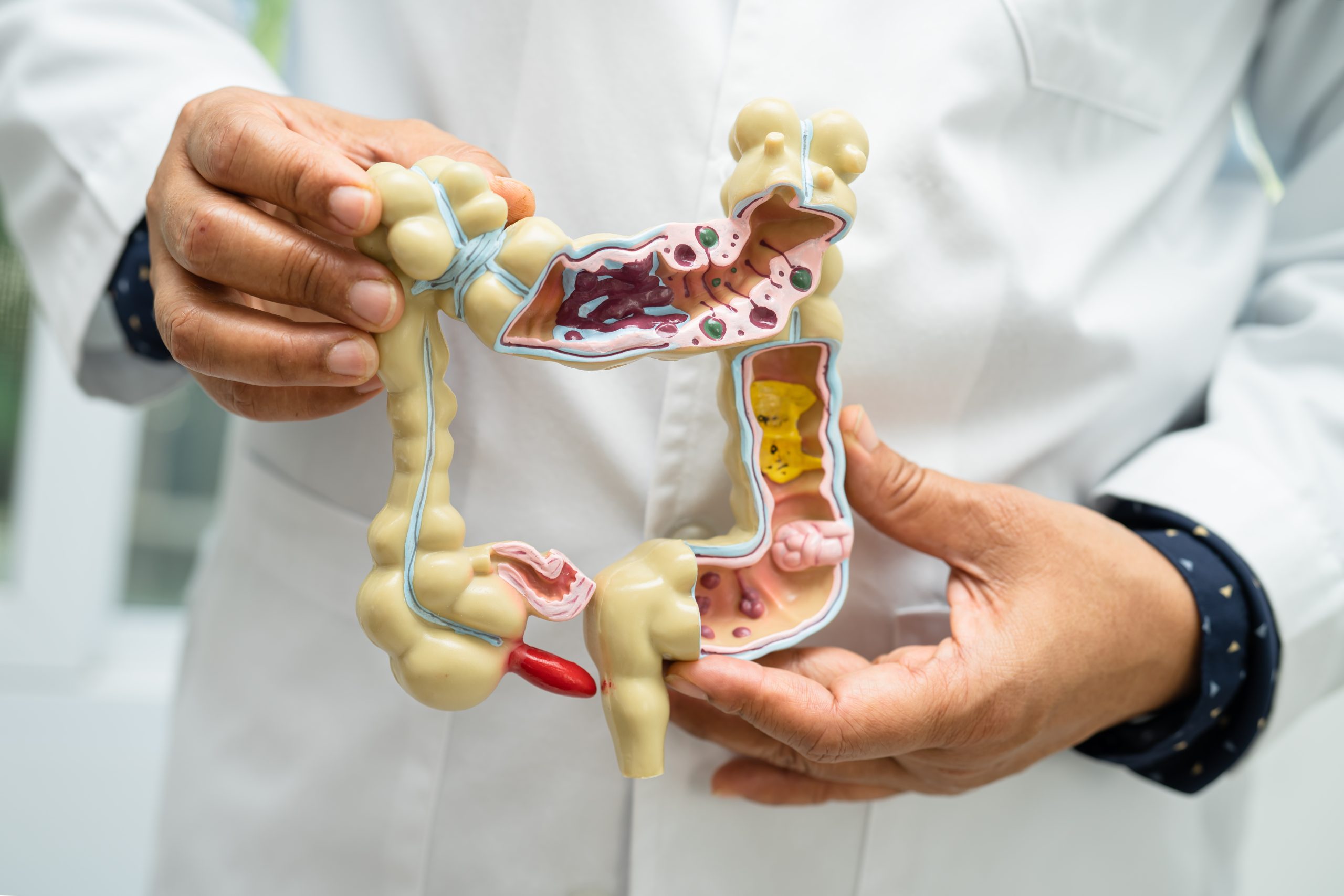 Qué es el cáncer de colon y recto: Síntomas, causas y prevención ...